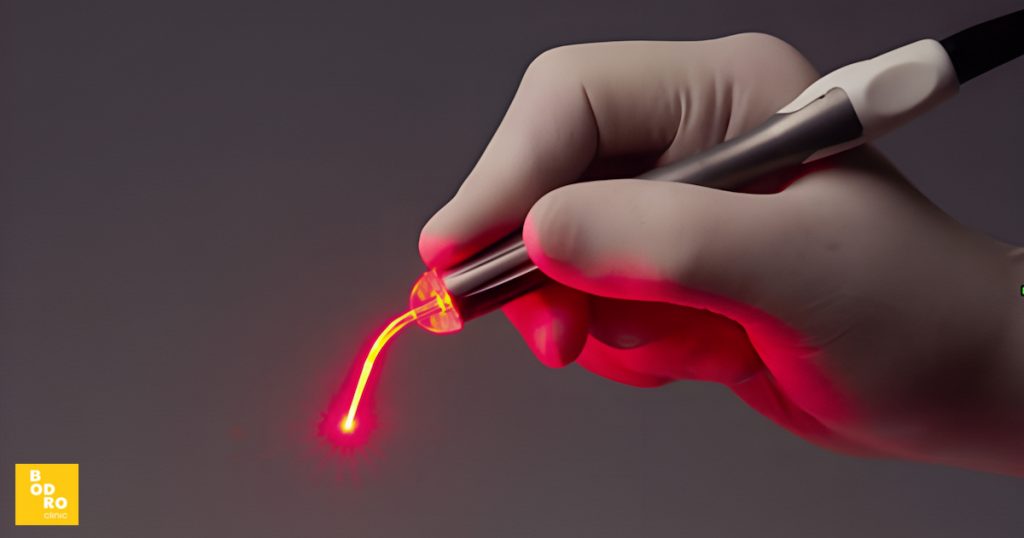 Лазерне лікування геморою (вапоризація) | Бодро Клінік